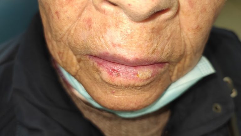 Cáncer de labios: las indicaciones son evitar el sol, usar protector y ...