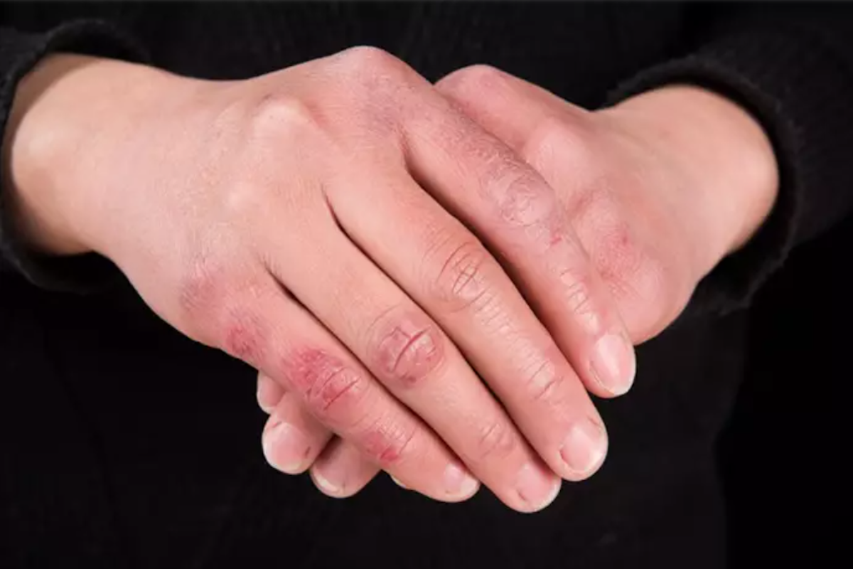 Eritemas pernios o sabañones: la indicación es evitar el frío y abrigar ...