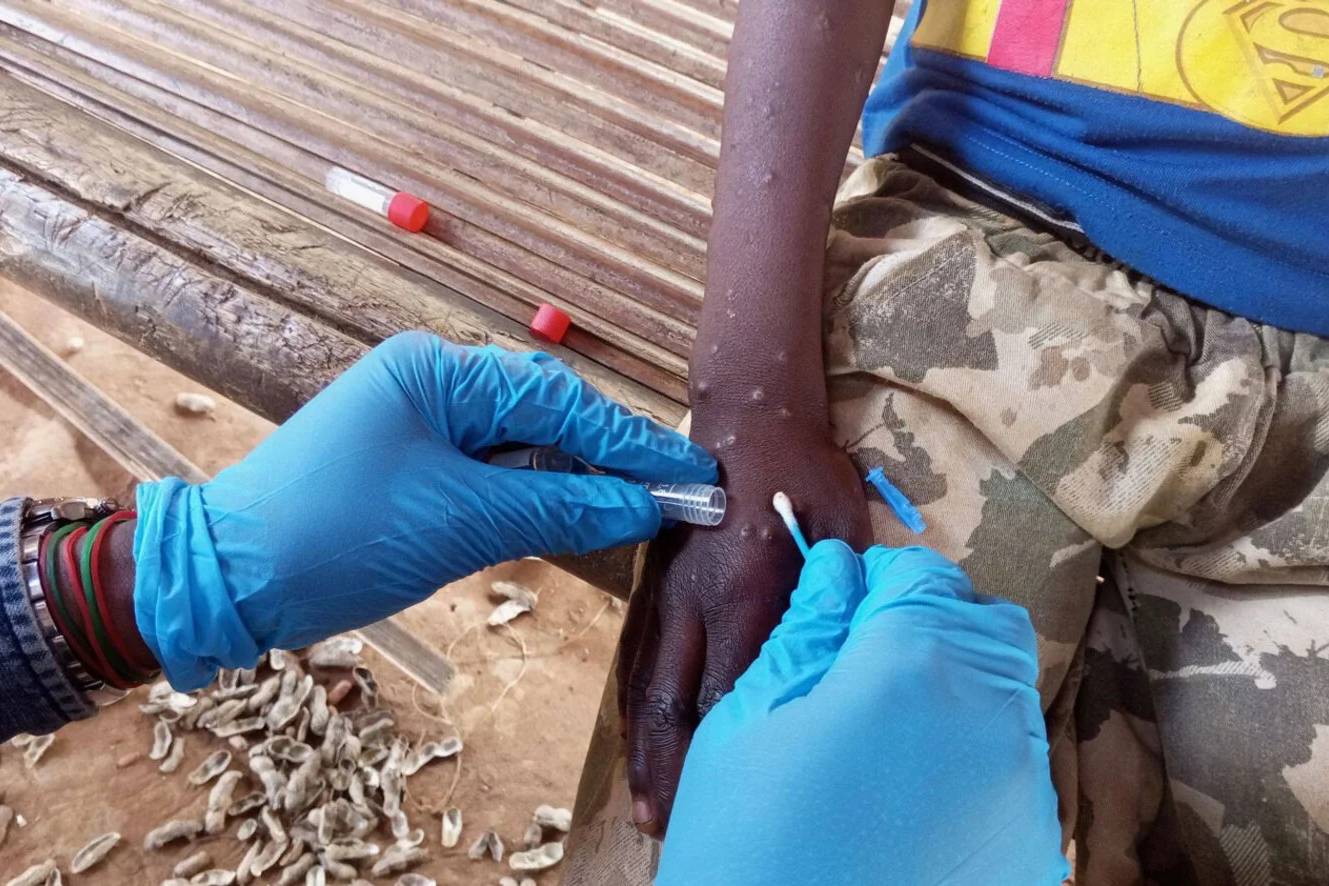 Aún sin casos en Chile: Mpox o “viruela del mono” un virus zoonótico ... Aún sin casos en Chile: Mpox o “viruela del mono” un virus zoonótico ...